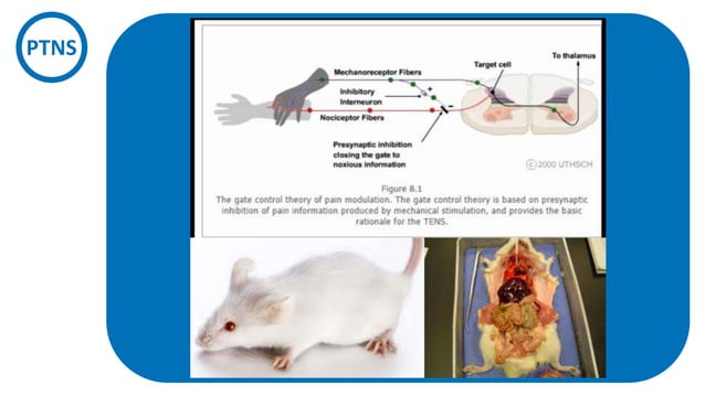 PTNS Percutaneous Tibial Nerve Stimulation | PPTX