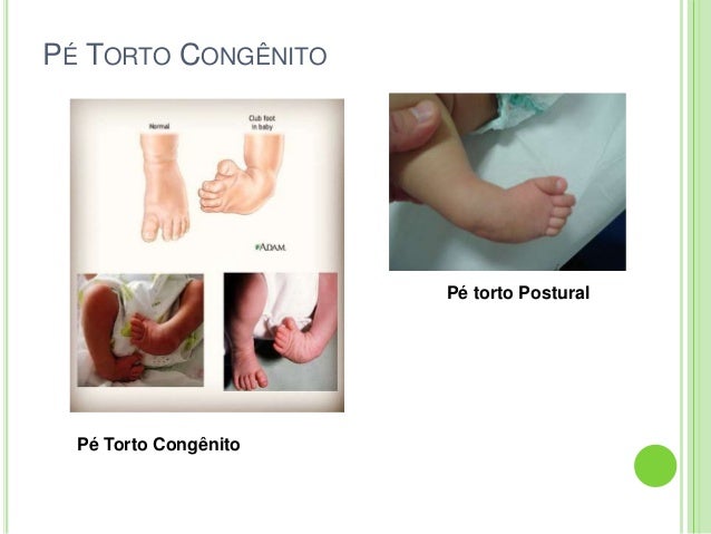 Pé torto congenito (clubfoot)