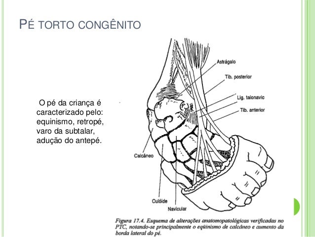 Pé torto congenito (clubfoot)