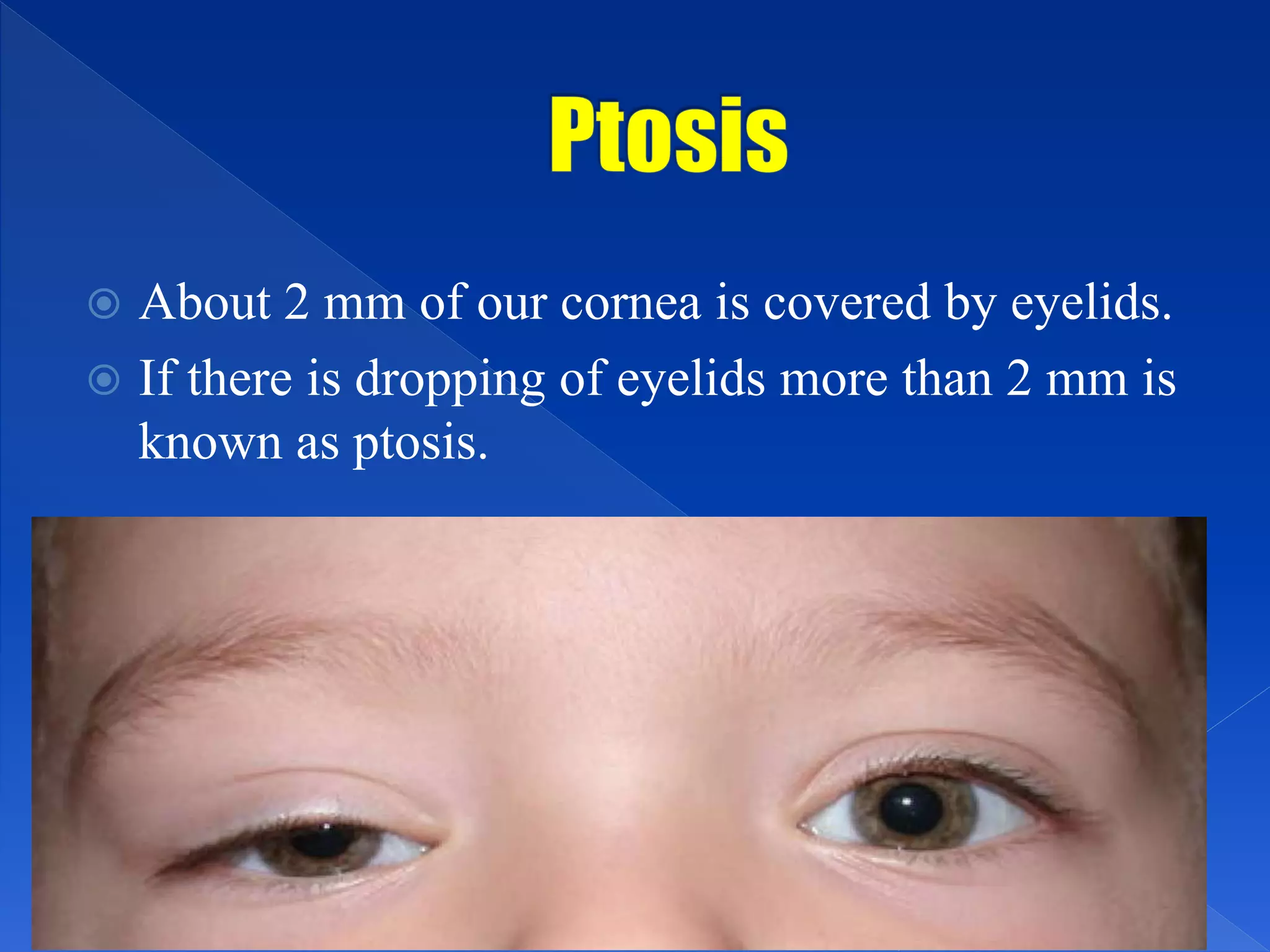 PTOSIS -Measurement and clinical evaluation | PPTX