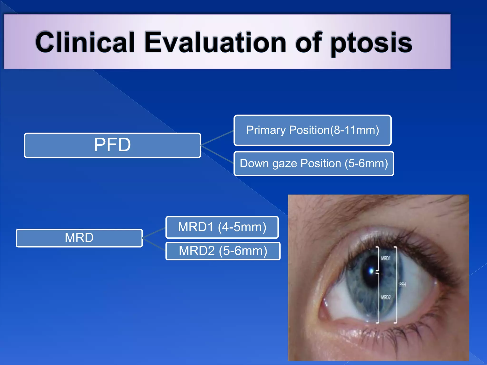 PTOSIS -Measurement and clinical evaluation | PPTX
