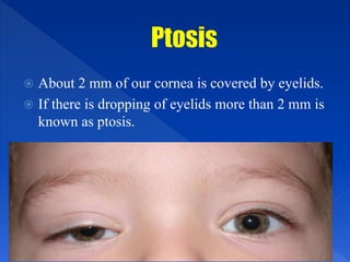 PTOSIS -Measurement and clinical evaluation | PPTX | Eye and Vision ...