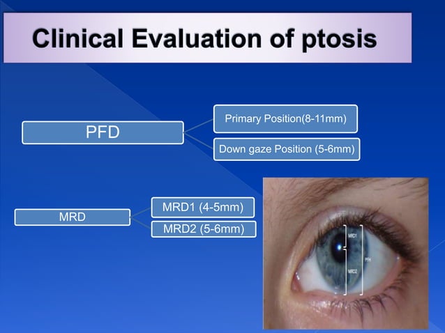 PTOSIS -Measurement and clinical evaluation | PPTX | Eye and Vision ...