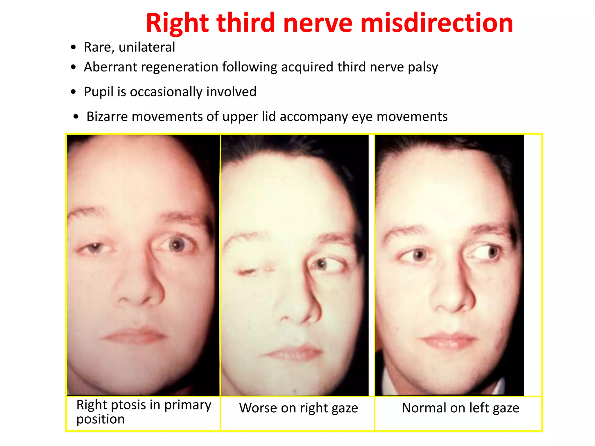 Ptosis | PPTX