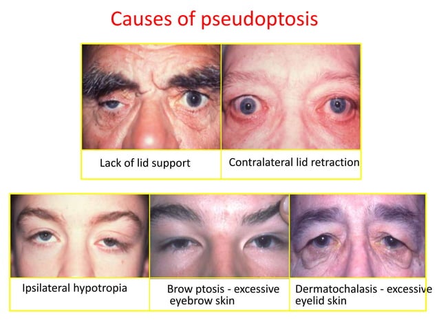 Ptosis | PPTX | Brain and Nervous System Disorders | Diseases and ...
