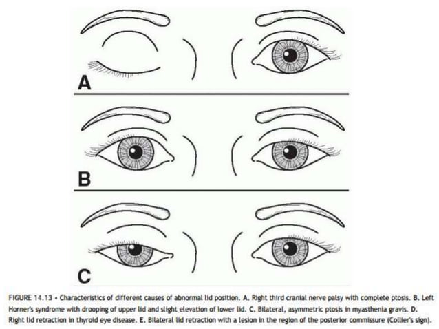 Ptosis | PPTX | Brain and Nervous System Disorders | Diseases and ...