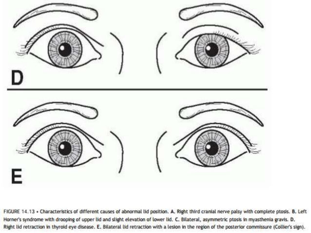 Ptosis | PPTX | Brain and Nervous System Disorders | Diseases and ...