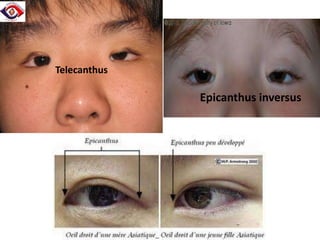 Ptosis | PPT