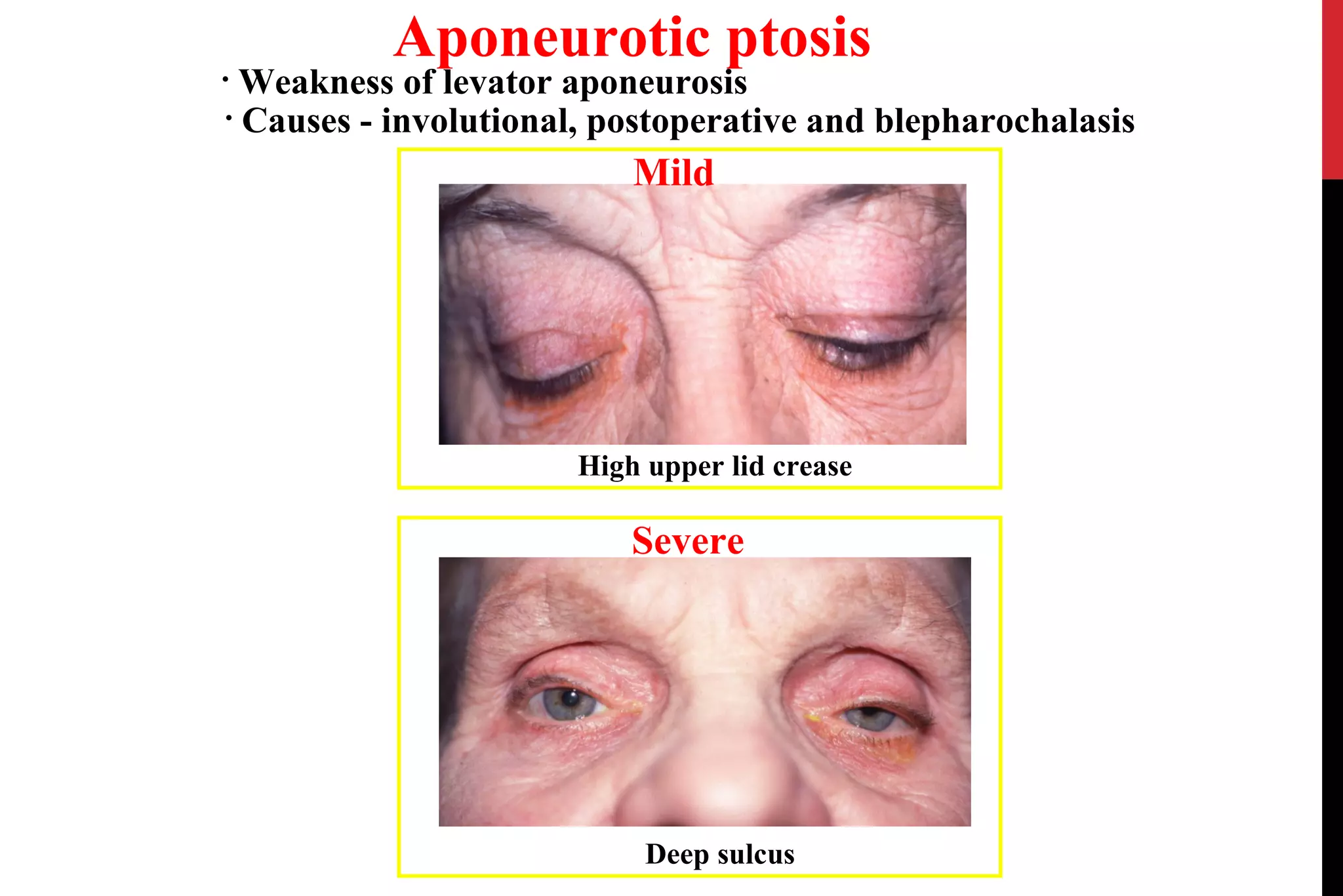 Ptosis | PPT