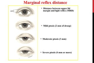 Ptosis | PPT | Eye and Vision Conditions | Diseases and Conditions