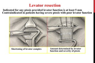 Ptosis | PPT | Eye and Vision Conditions | Diseases and Conditions