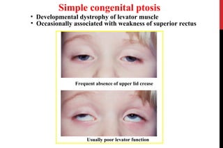 Ptosis | PPT