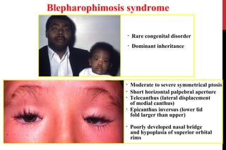 Ptosis | PPT | Eye and Vision Conditions | Diseases and Conditions