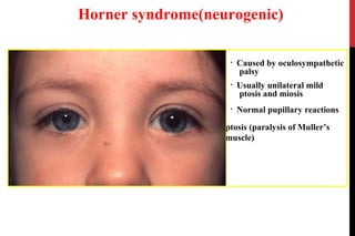 Ptosis | PPT | Eye and Vision Conditions | Diseases and Conditions