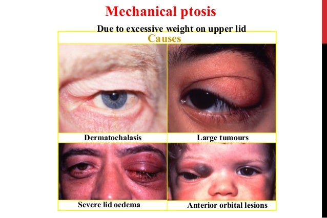 Ptosis