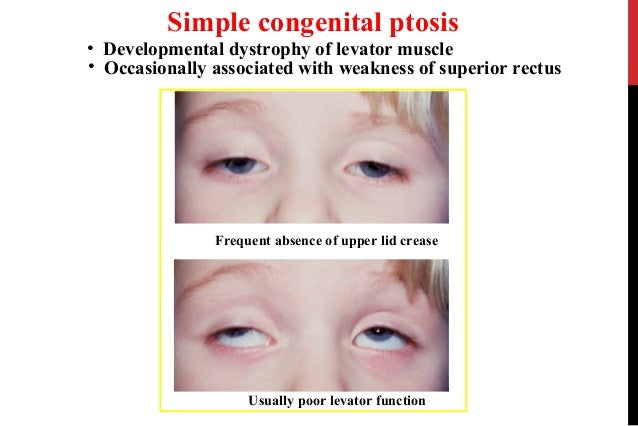 Ptosis