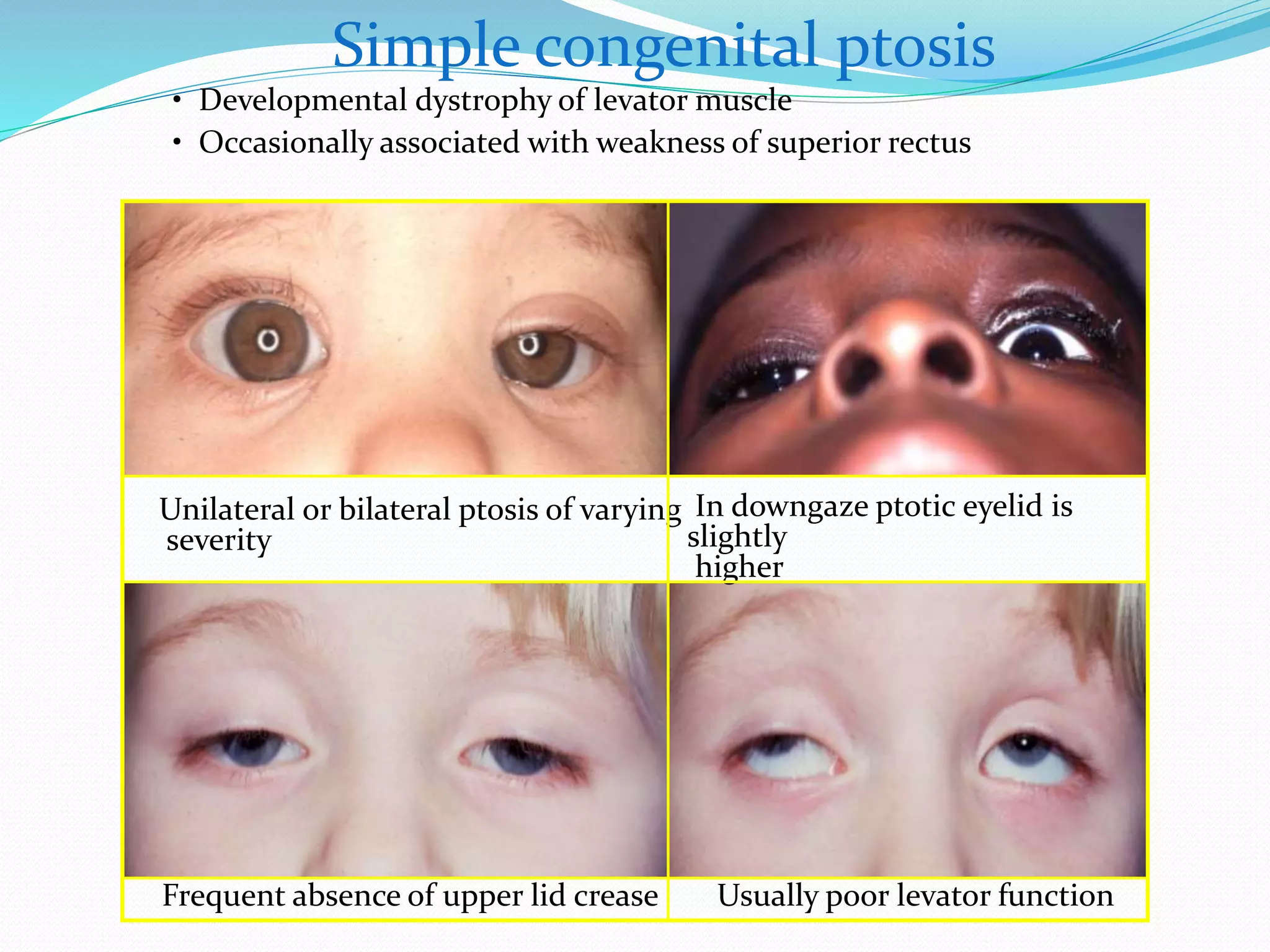 Ptosis | PPTX