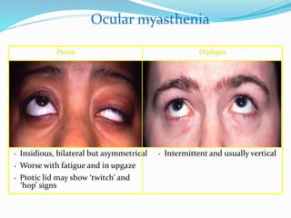 Ptosis | PPTX