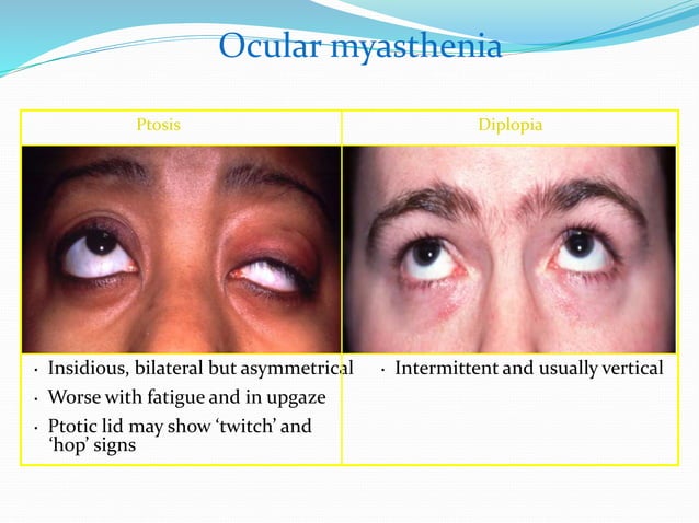 Ptosis | PPT