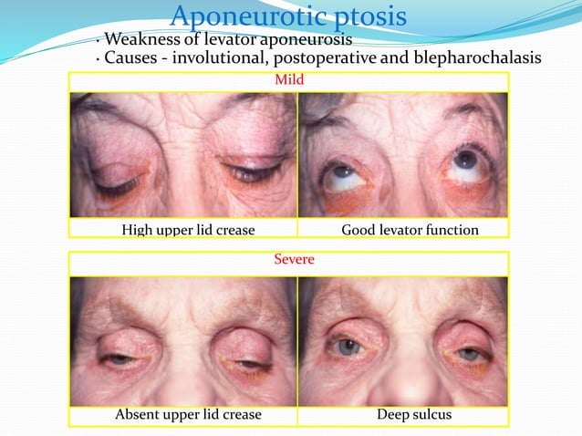 Ptosis | PPTX | Eye and Vision Conditions | Diseases and Conditions