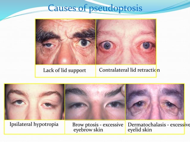 Ptosis | PPTX | Eye and Vision Conditions | Diseases and Conditions