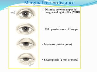Ptosis | PPTX