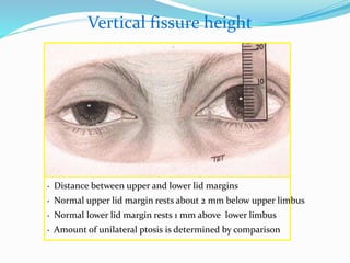 Ptosis | PPTX