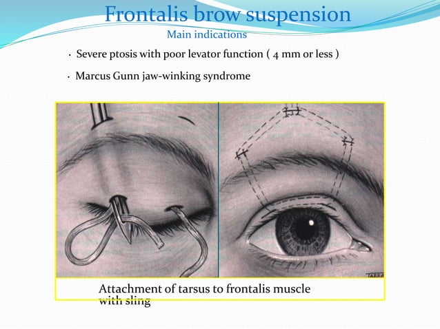 Ptosis | PPTX | Eye and Vision Conditions | Diseases and Conditions