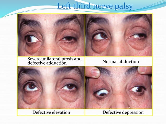 Ptosis | PPTX | Eye and Vision Conditions | Diseases and Conditions