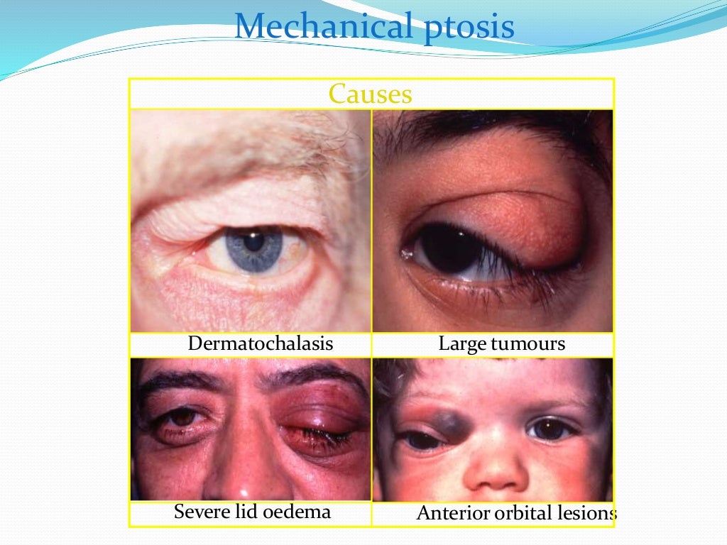 Ptosis