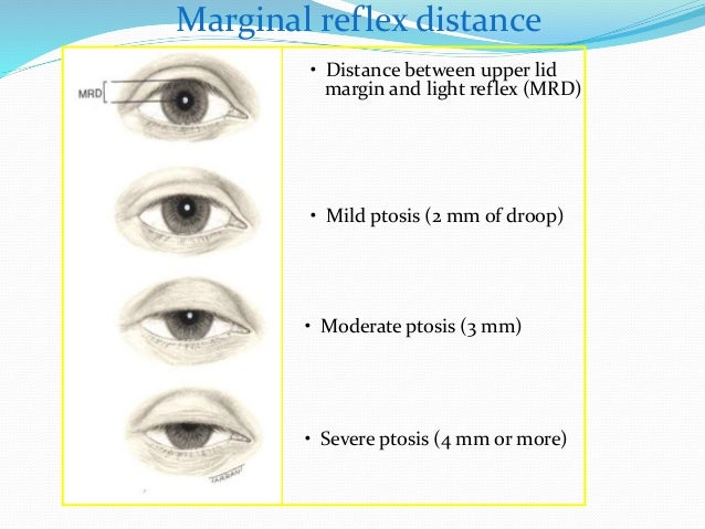 Ptosis