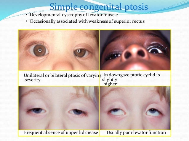 Ptosis