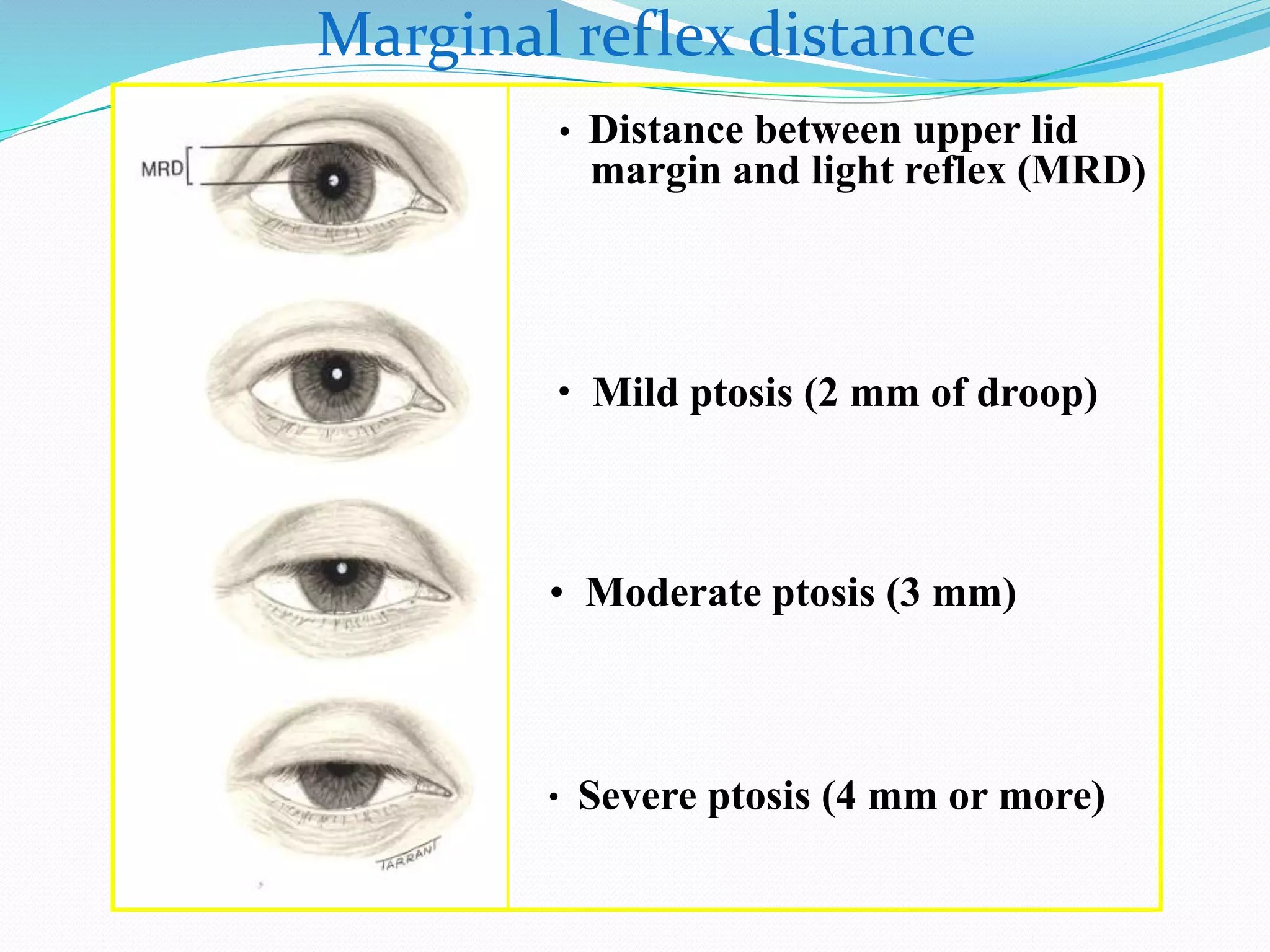 Ptosis | PPTX