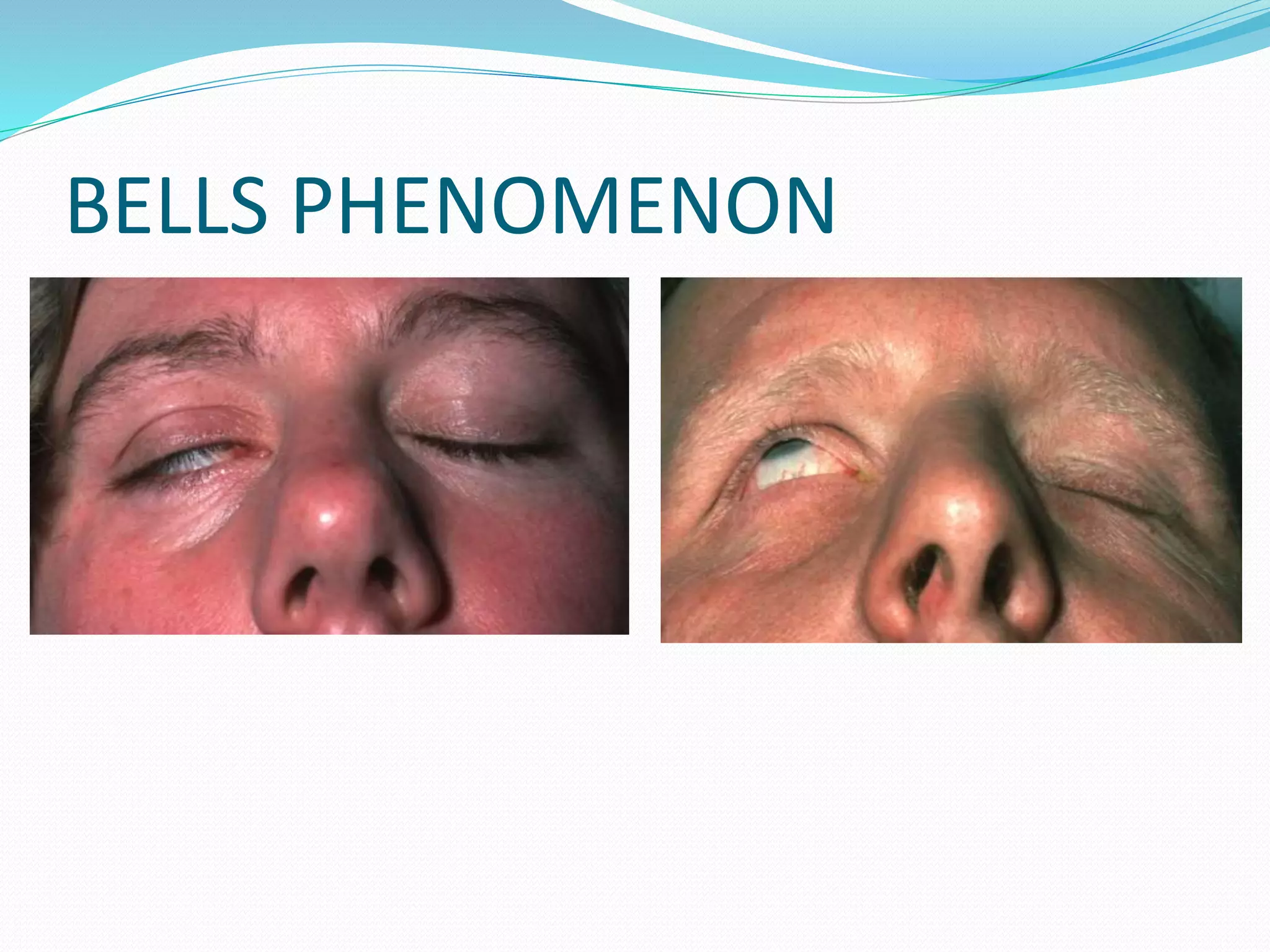 Ptosis | PPTX