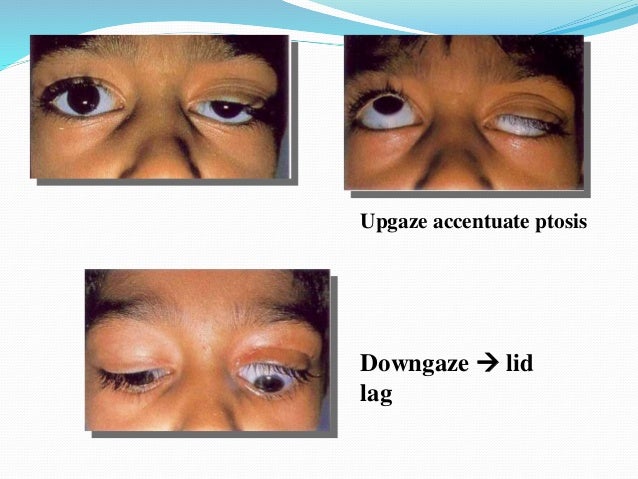 What Is Lid Lag With Pictures Thyroid Eye Disease: A Southeast Asian