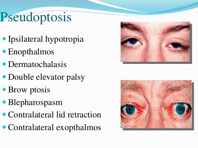 Ptosis