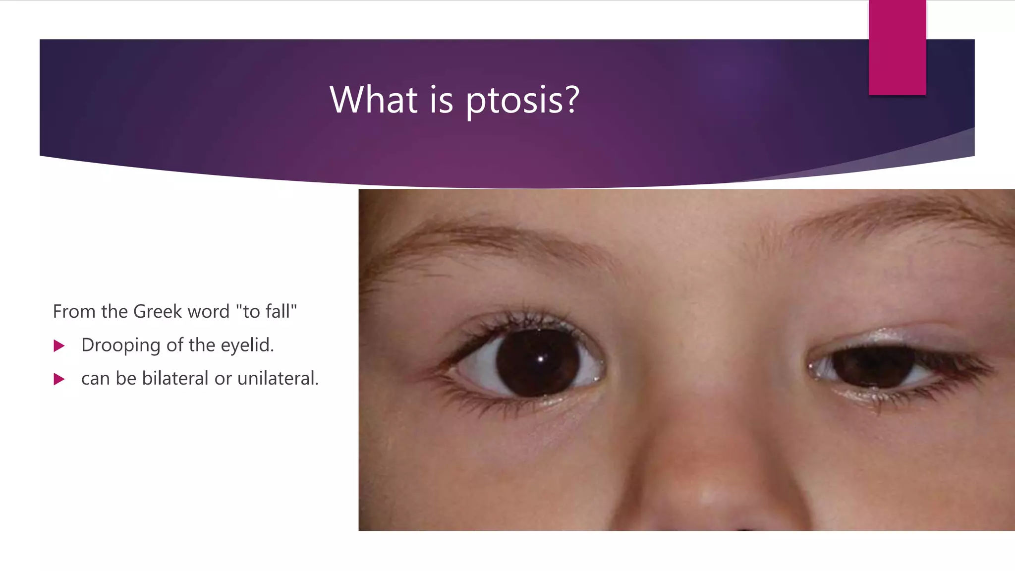 Ptosis | PPTX