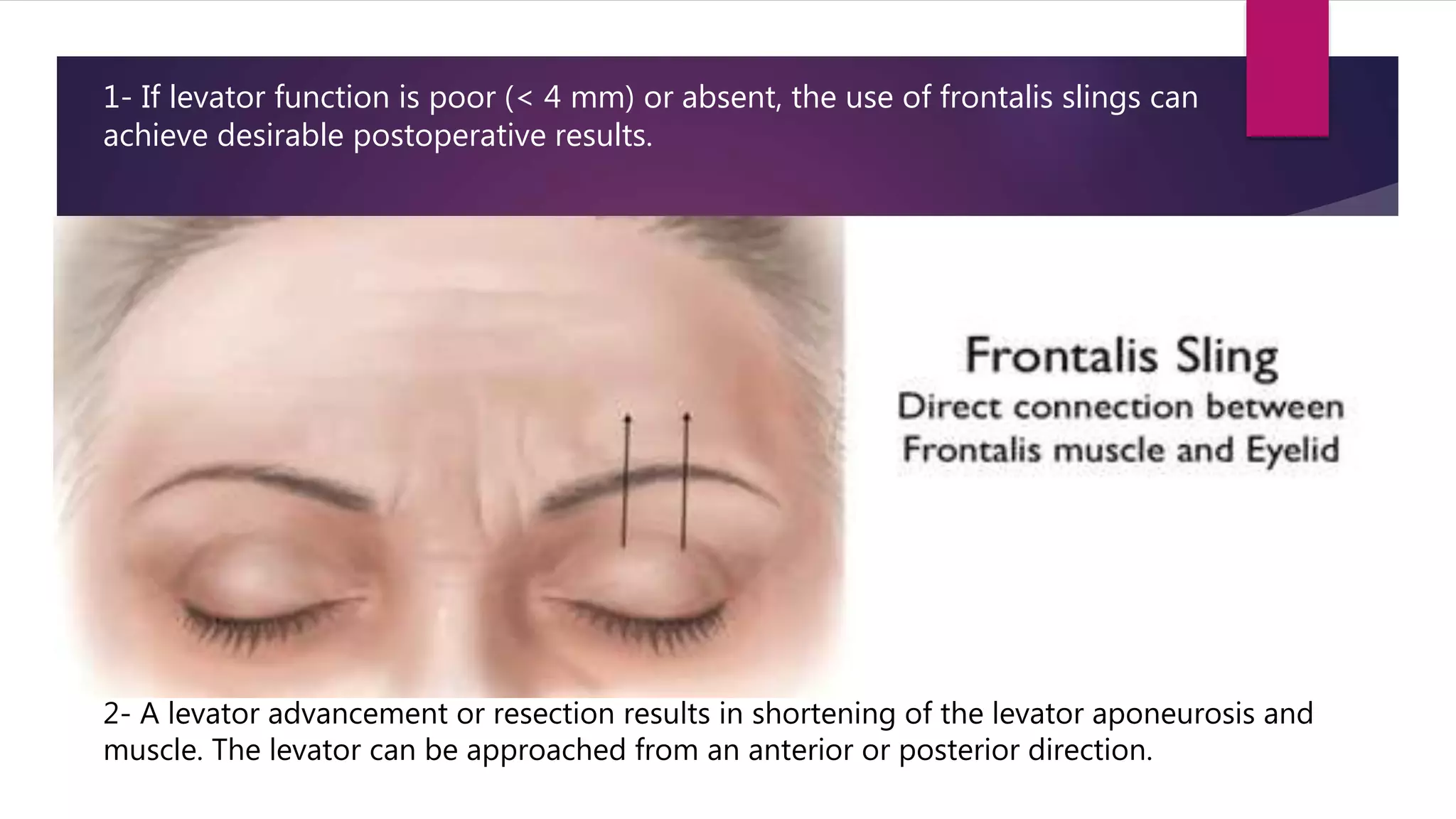 Ptosis | PPTX