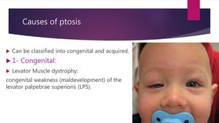 Ptosis | PPTX