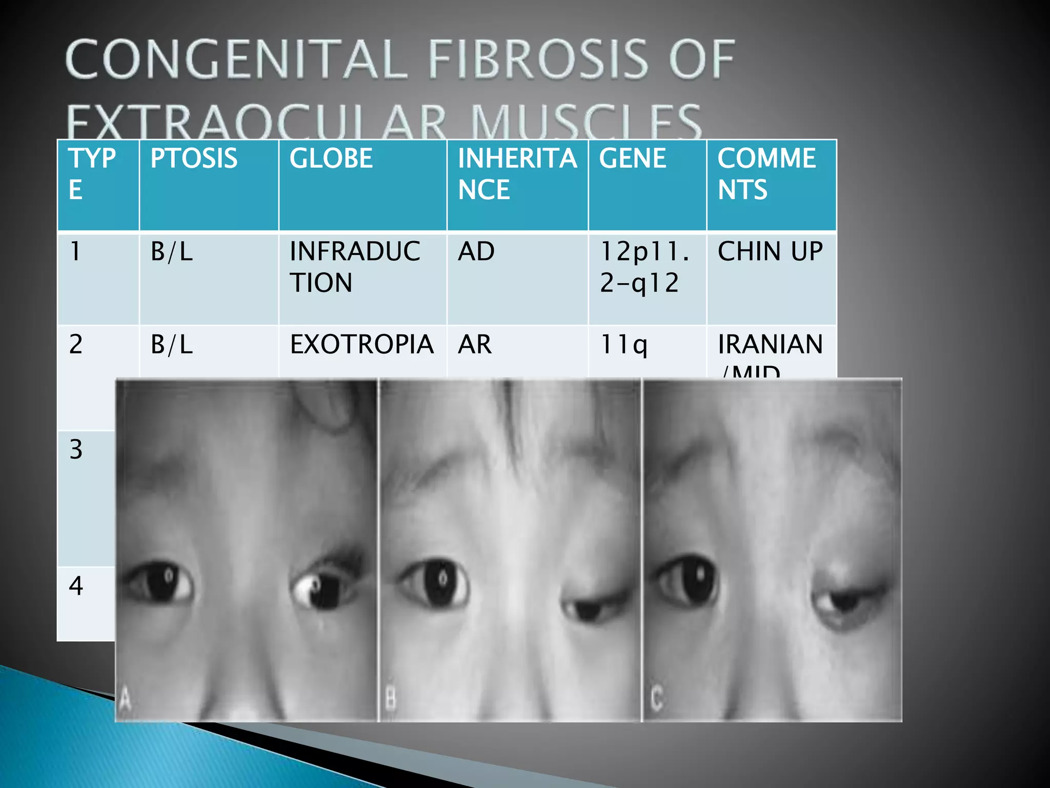 Ptosis | PPTX
