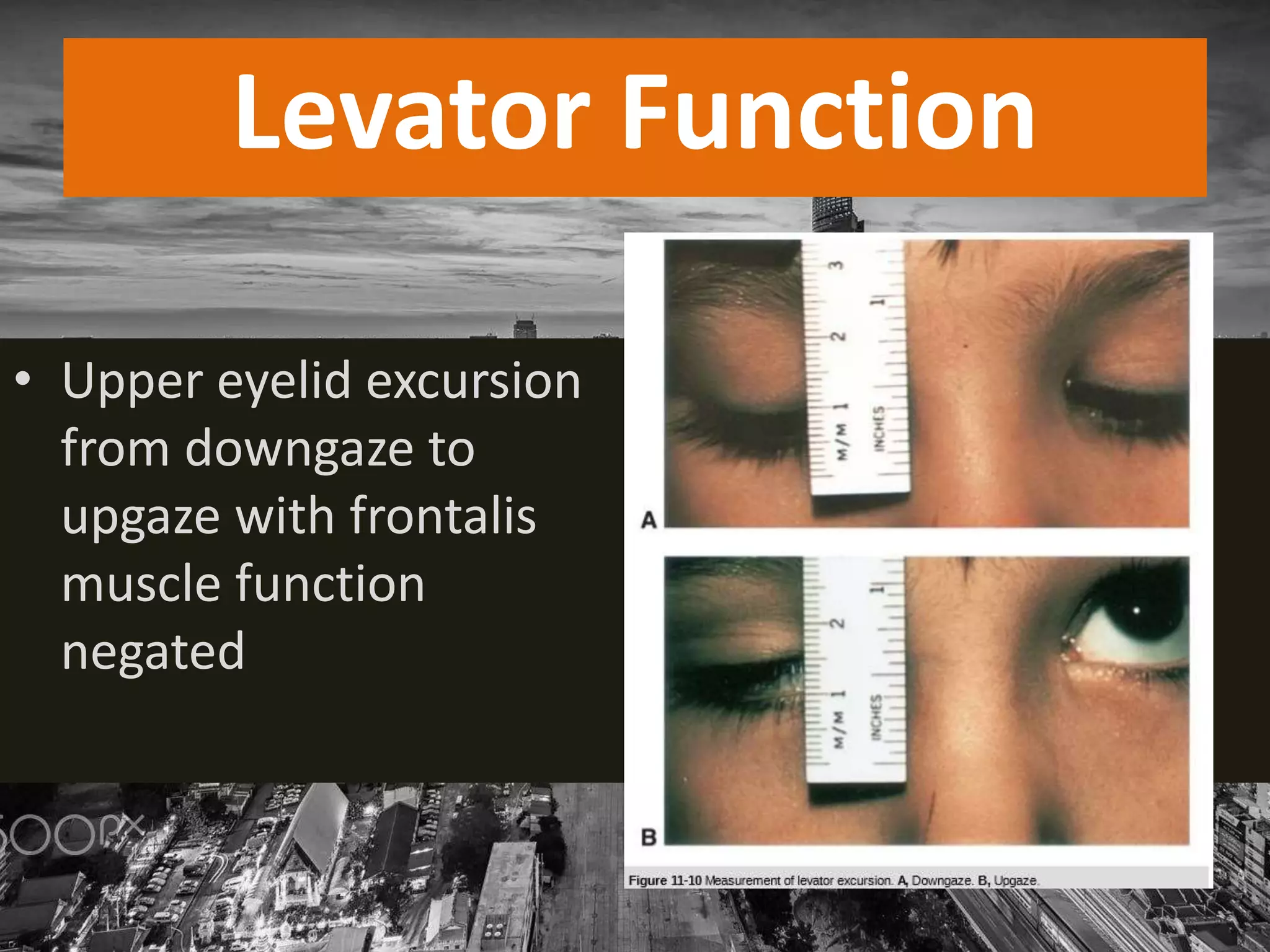 blepharoptosis | PPTX