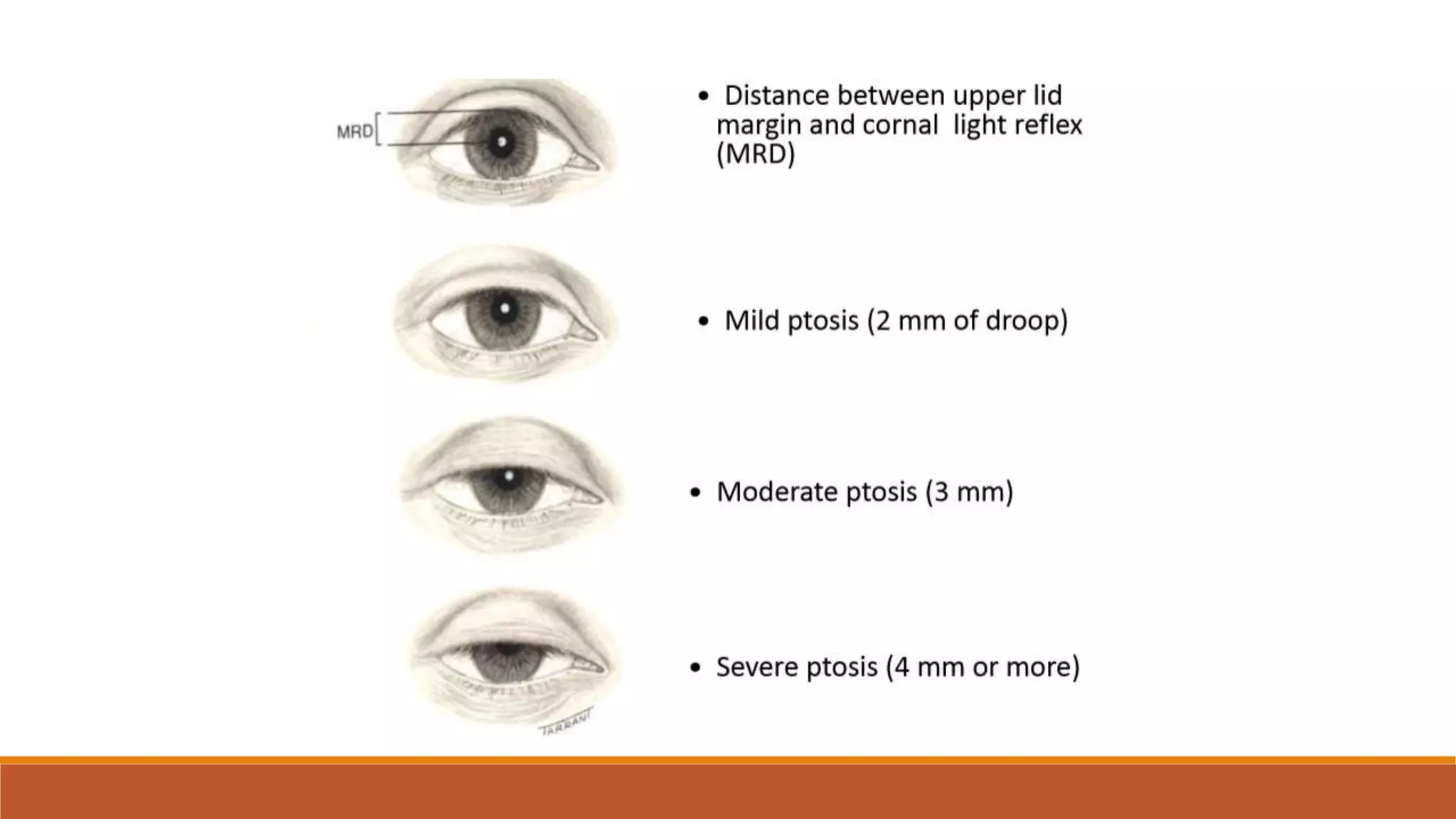 Ptosis | PPTX