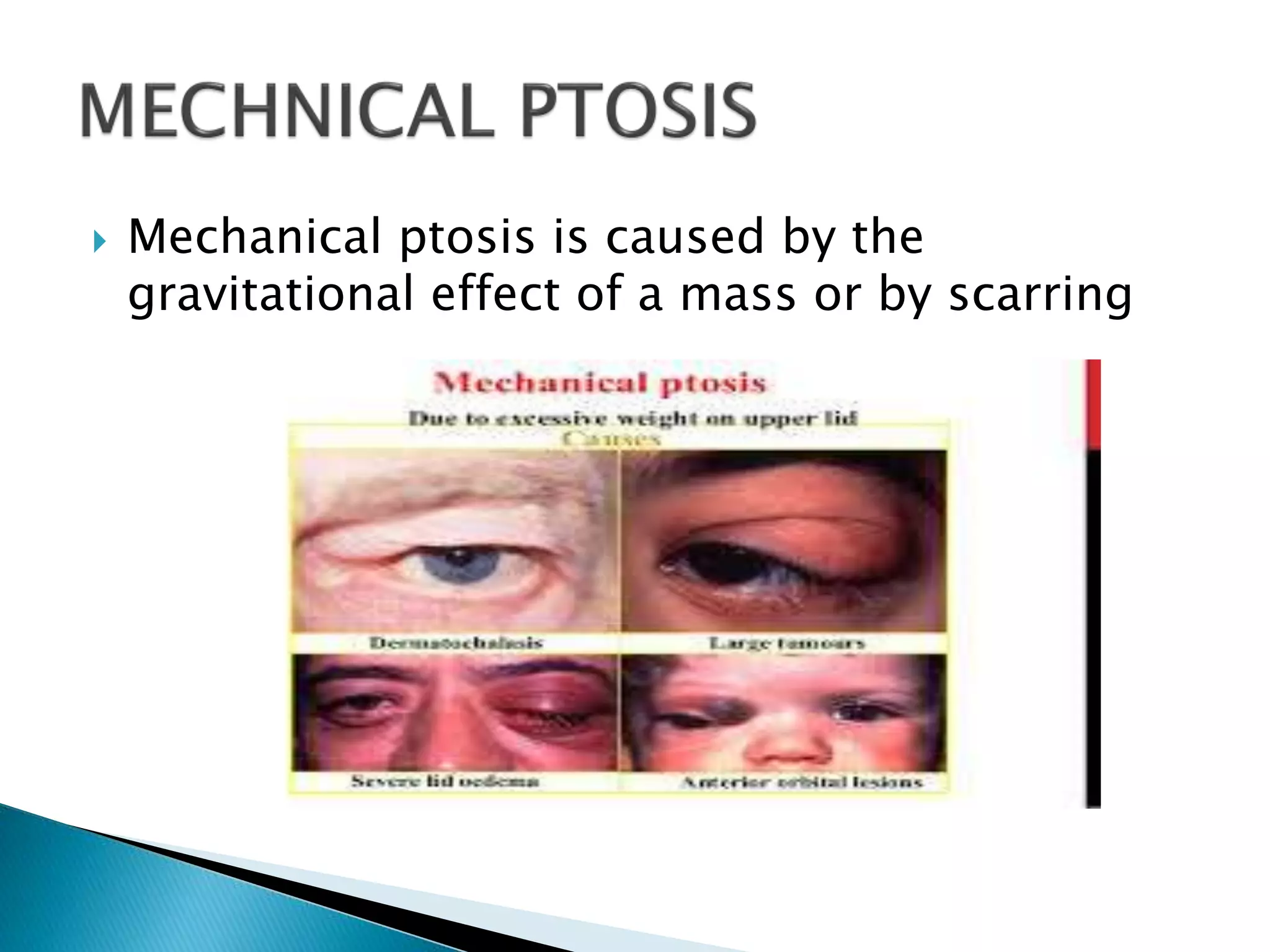 Ptosis eyelid disorders | PPTX