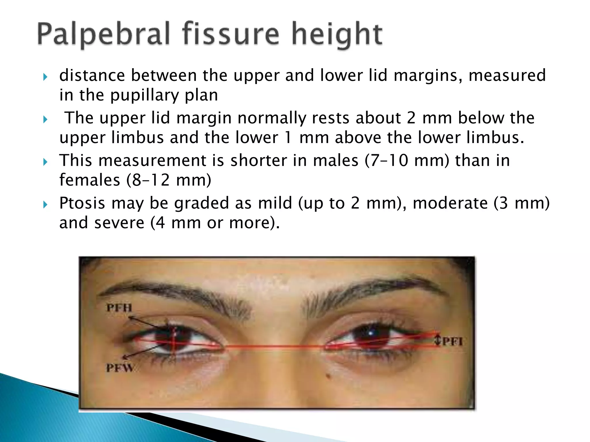 Ptosis eyelid disorders | PPTX
