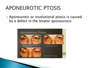 Ptosis eyelid disorders | PPTX