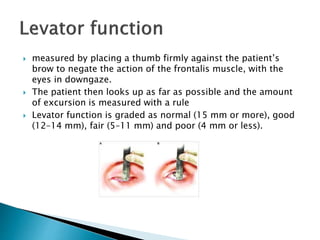Ptosis eyelid disorders | PPTX