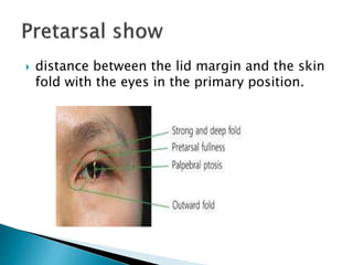 Ptosis eyelid disorders | PPTX