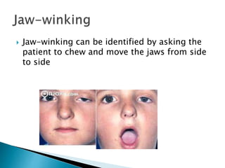 Ptosis eyelid disorders | PPTX