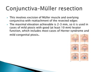 Ptosis eyelid disorders | PPTX