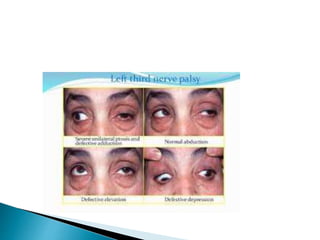 Ptosis eyelid disorders | PPTX